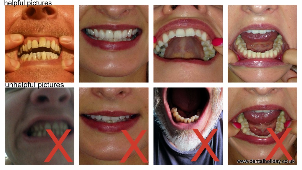 Free dental consultation with your photographs - Dental Holiday